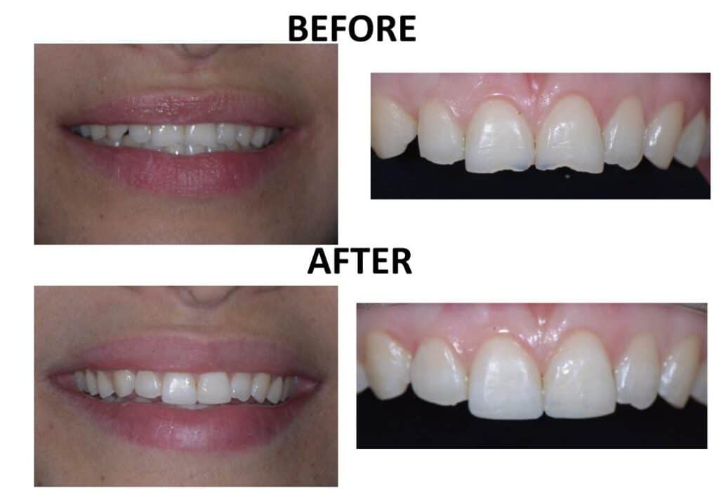 BEST Tooth Contouring in NYC - Before and After Photos of Tooth ...